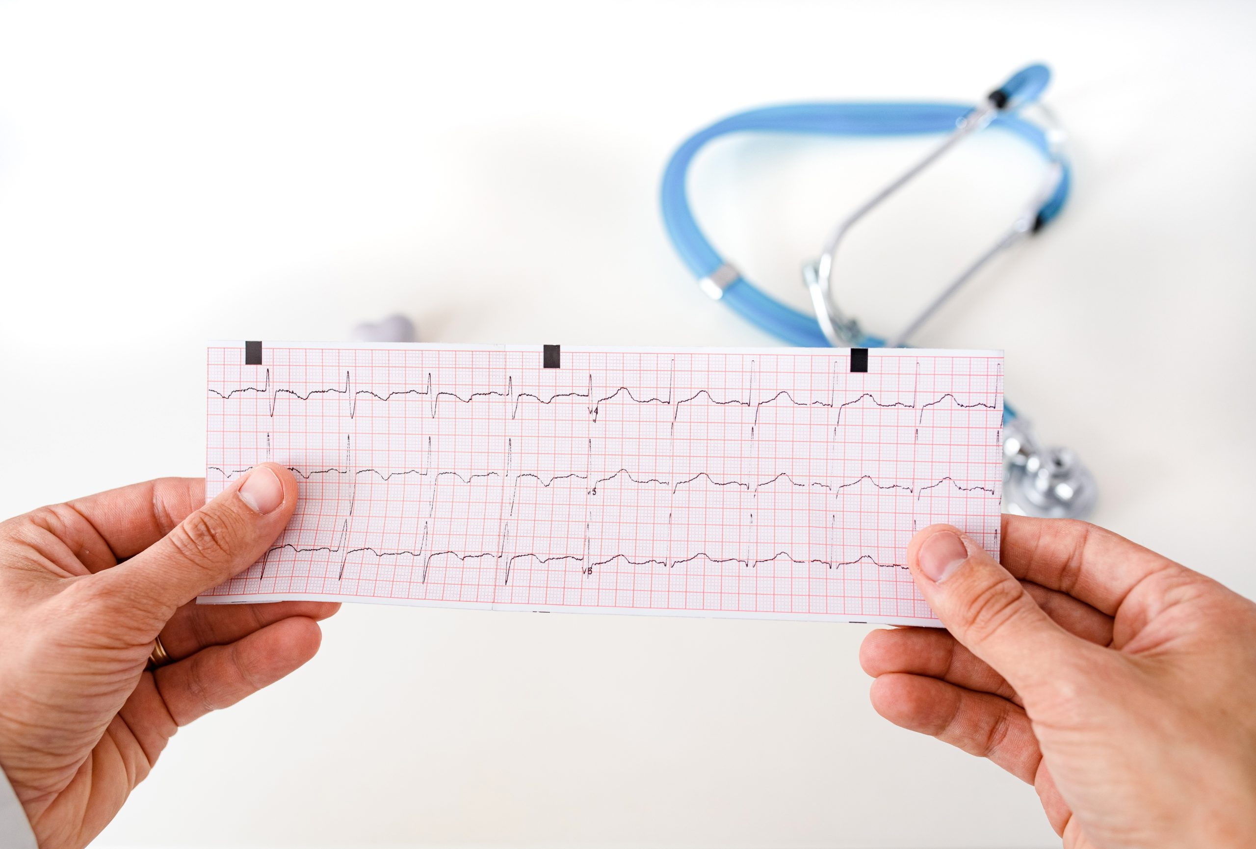 Ce trebuie să știi despre Aritmiile Cardiace?