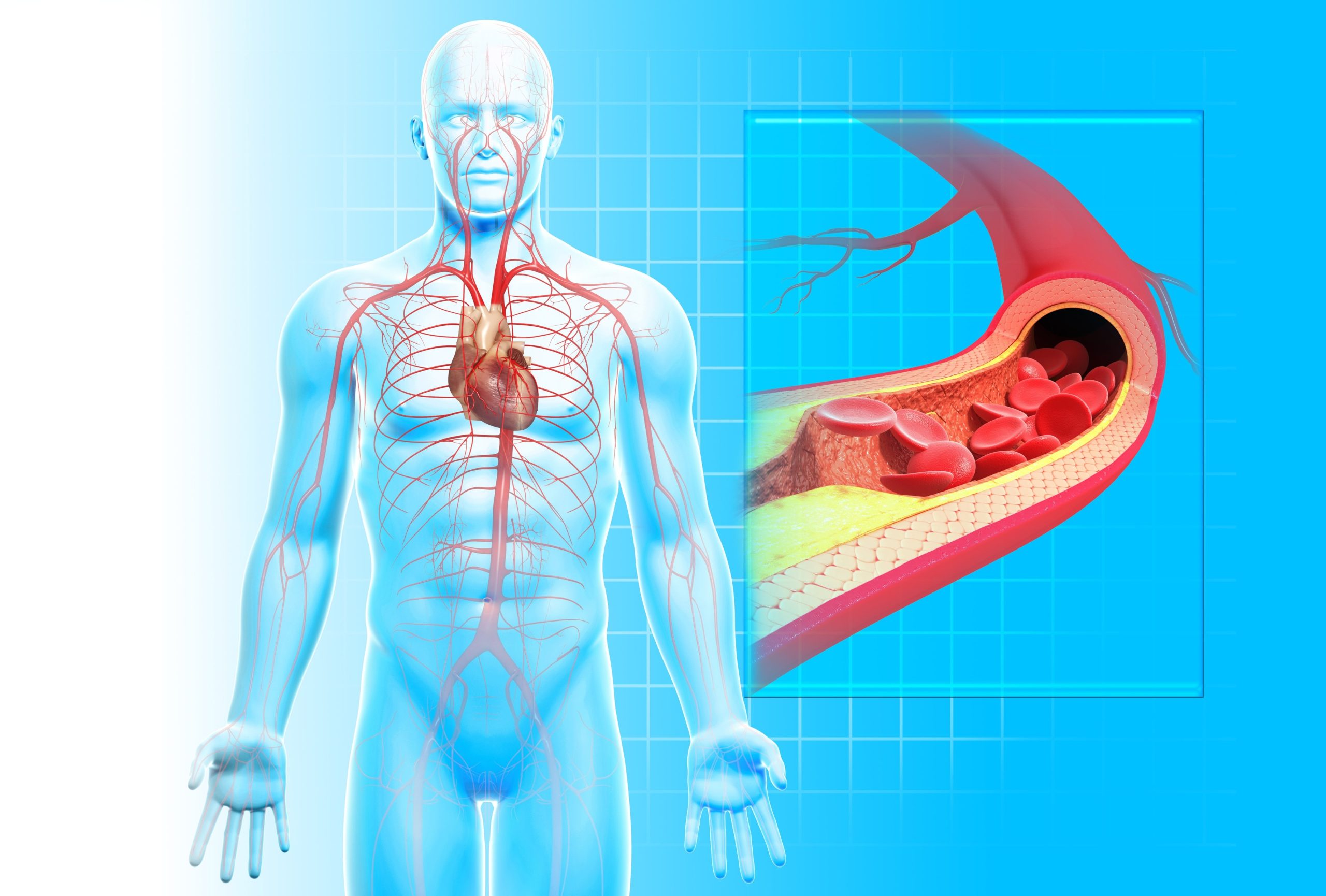 Bolile Arterelor Coronare: Infarct și Angină Pectorală